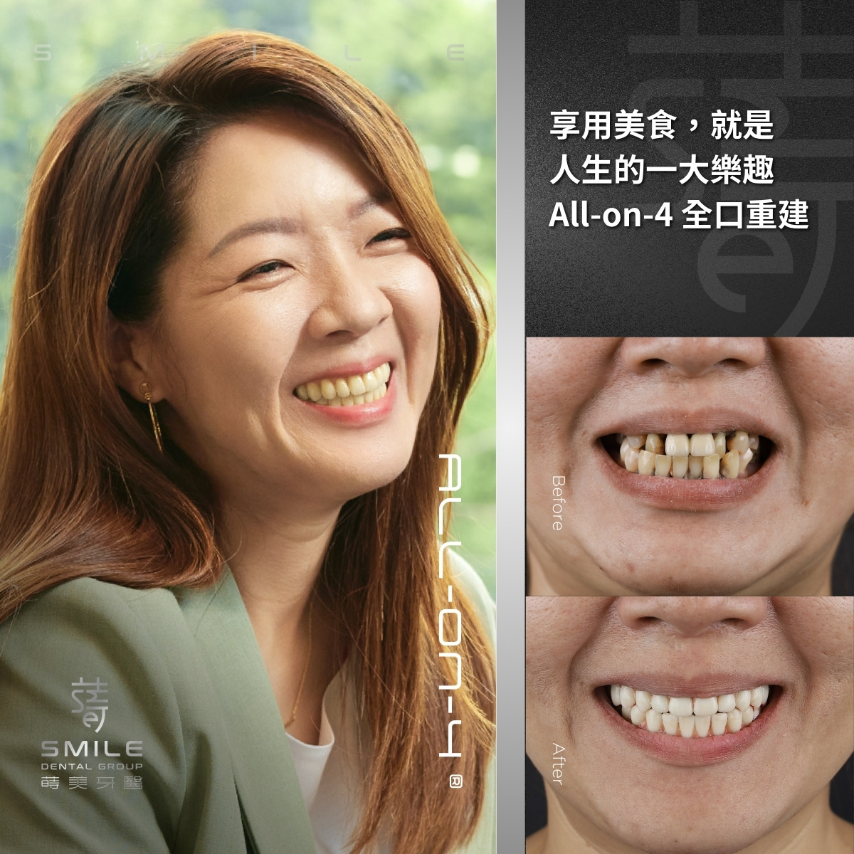 [All-on-4懶人包] 一篇搞懂 All-on-4 流程、優缺點、費用及副作用 - 蒔美牙醫集團