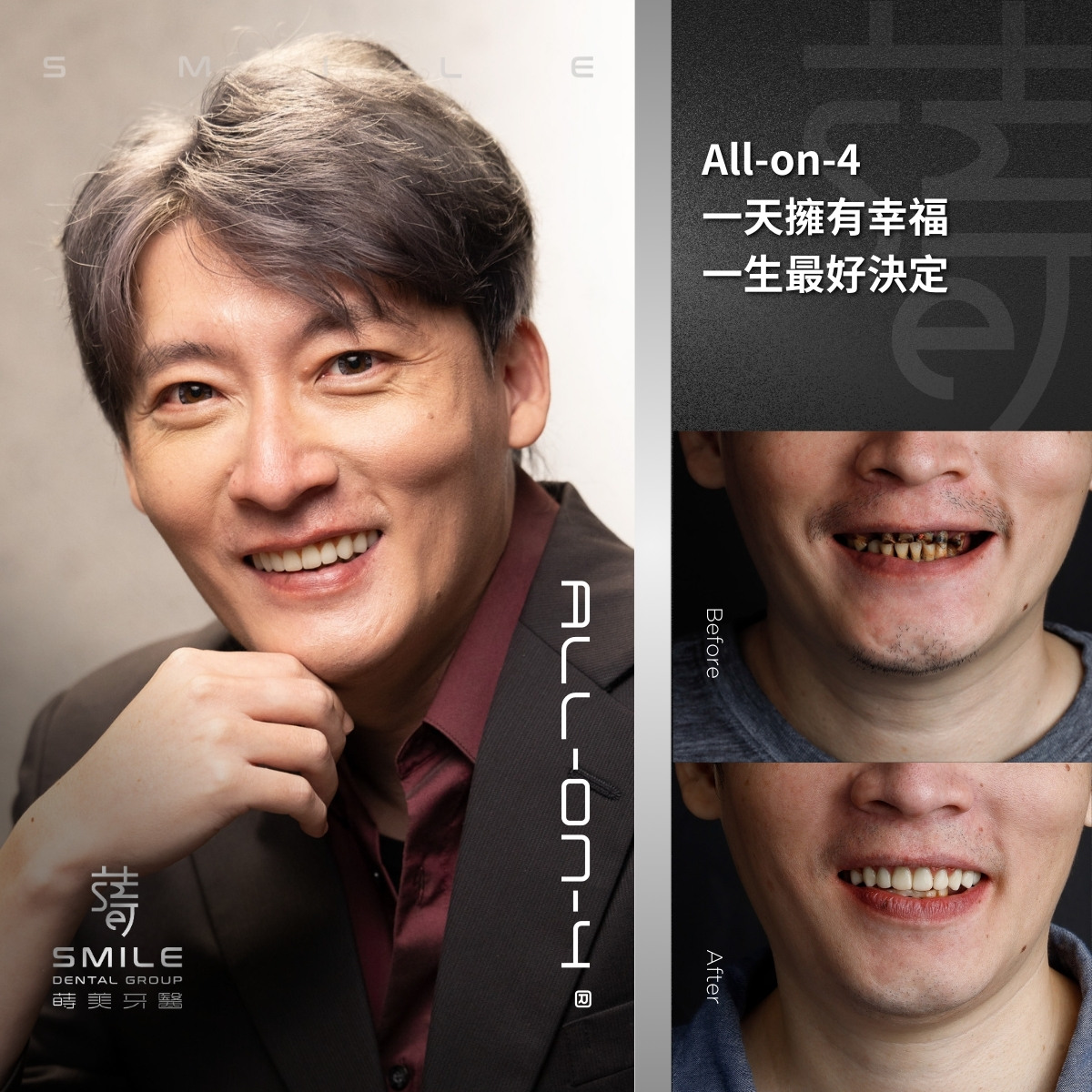 All-on-4全口植牙，一天擁有幸福，一生最好決定 - 蒔美牙醫集團